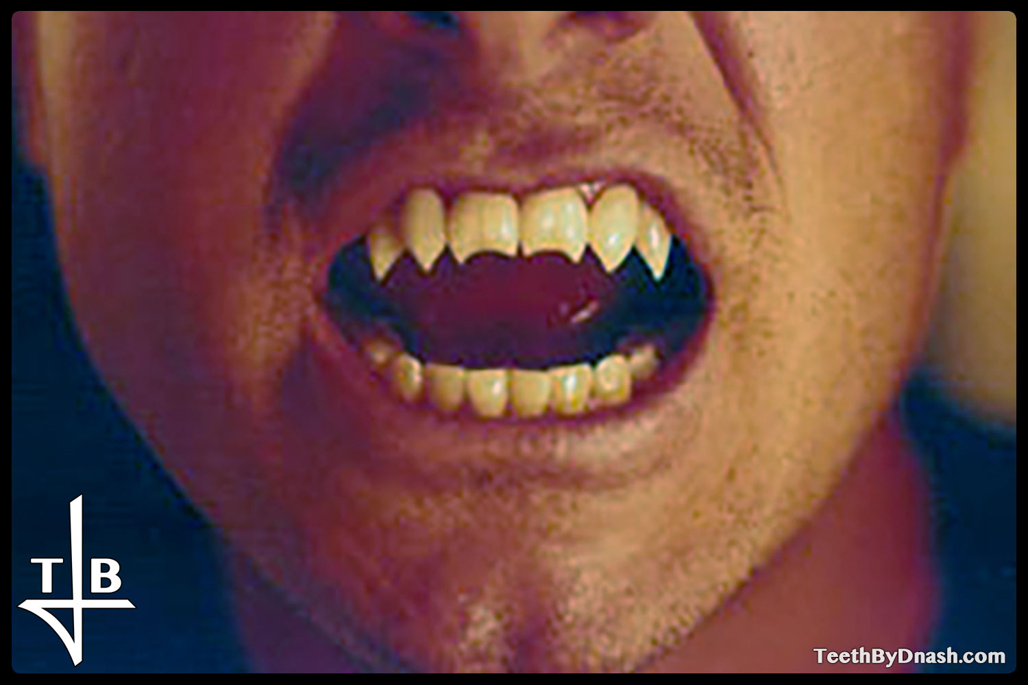 Angelus - Teeth By Dnash